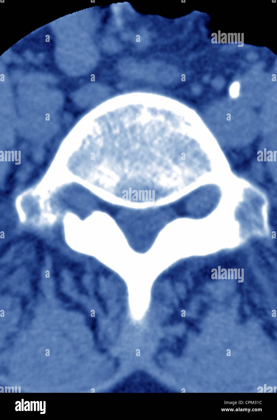 HERNIATED DISK, SCAN Stock Photo - Alamy