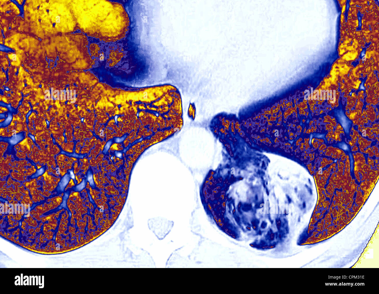 LUNG CANCER, SCAN Stock Photo - Alamy