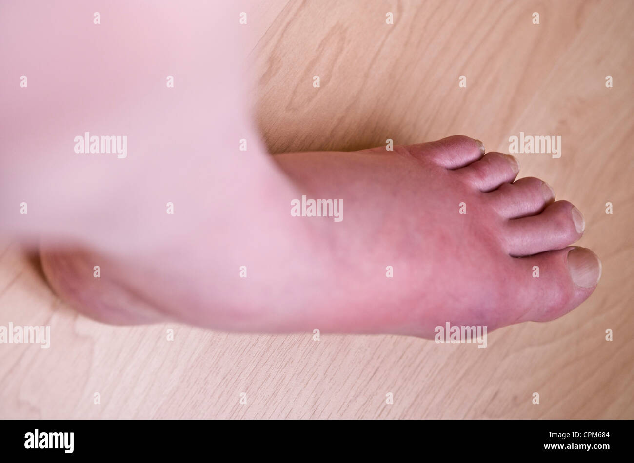 Gout man hi-res stock photography and images - Alamy