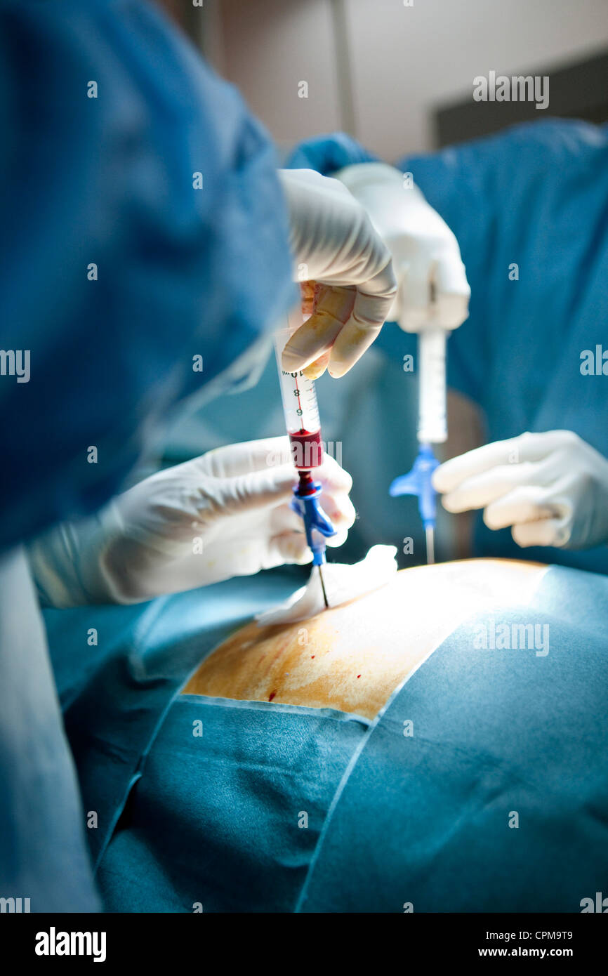 Bone marrow aspiration hi-res stock photography and images - Alamy