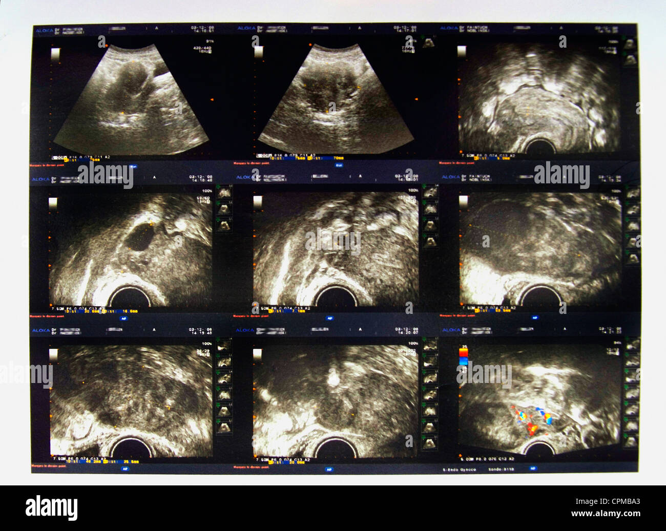 Fibroma hi-res stock photography and images - Alamy