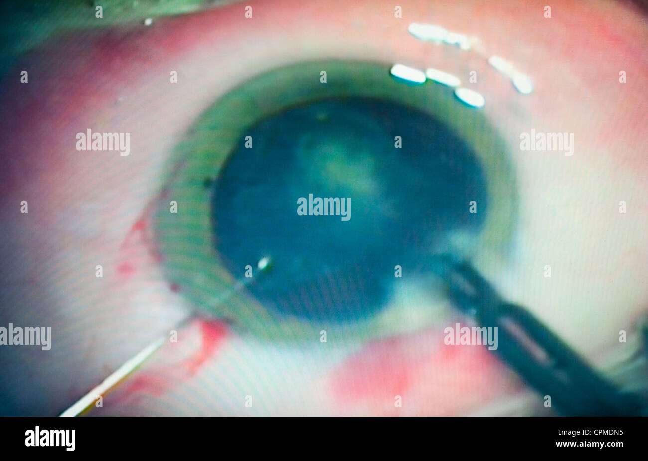 Prosthetic intra ocular lens implants hi-res stock photography and ...