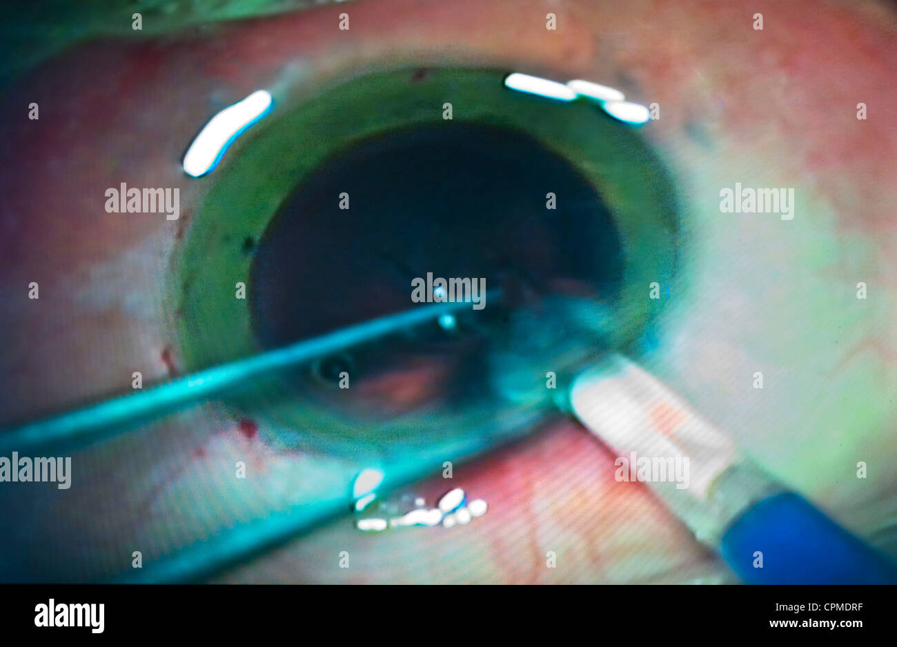 Prosthetic intraocular lenses hi-res stock photography and images - Alamy