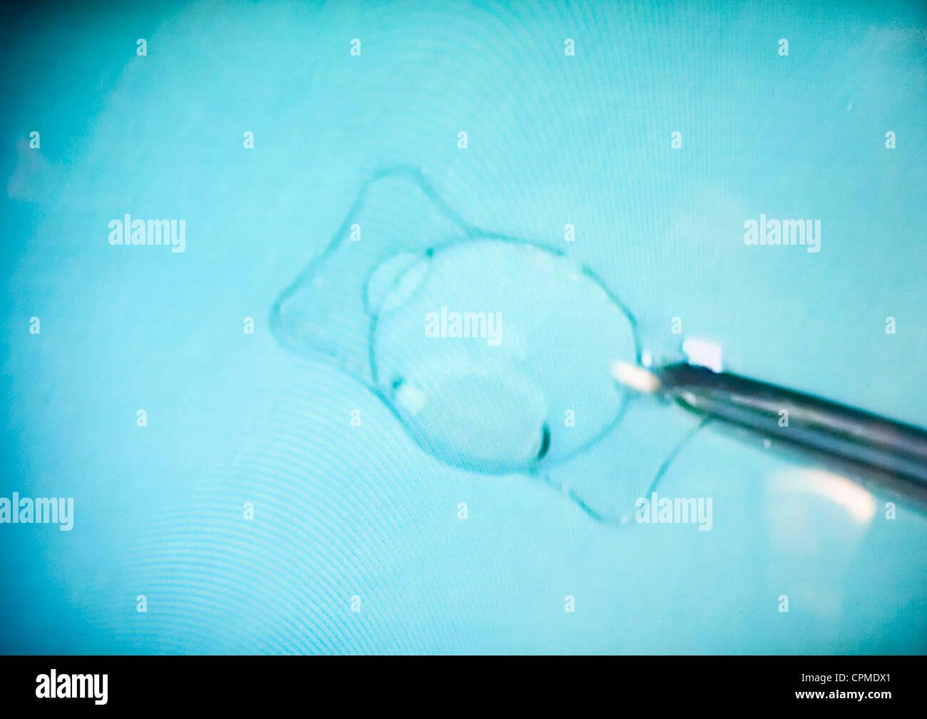 Prosthetic intra ocular lens implants hi-res stock photography and ...