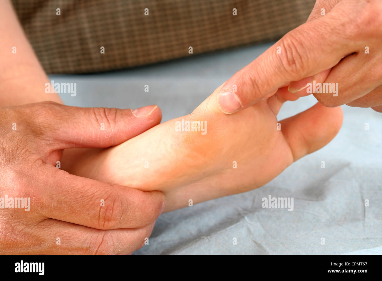 Wart child hi-res stock photography and images - Alamy