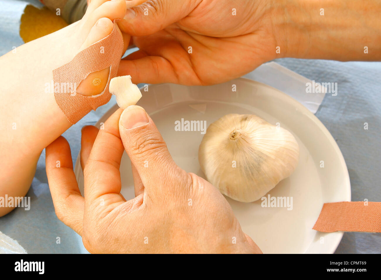 Wart child hi-res stock photography and images - Alamy