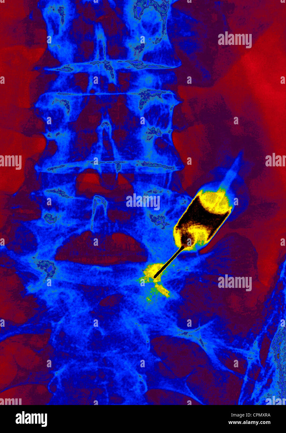Vertebrae x ray hi-res stock photography and images - Alamy