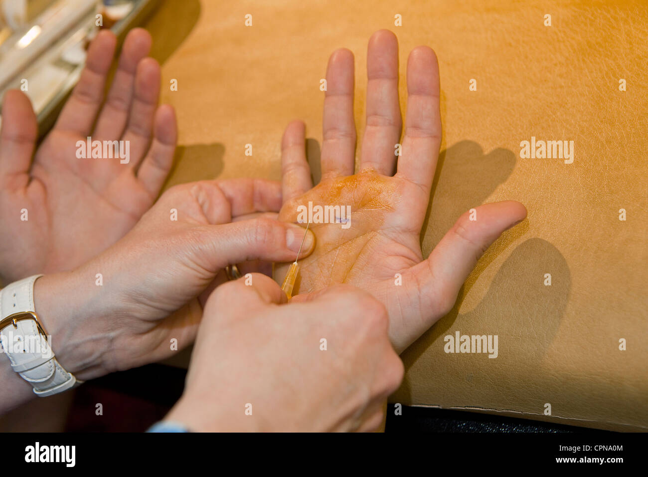 Infiltration Medical Stock Photos & Infiltration Medical Stock Images ...