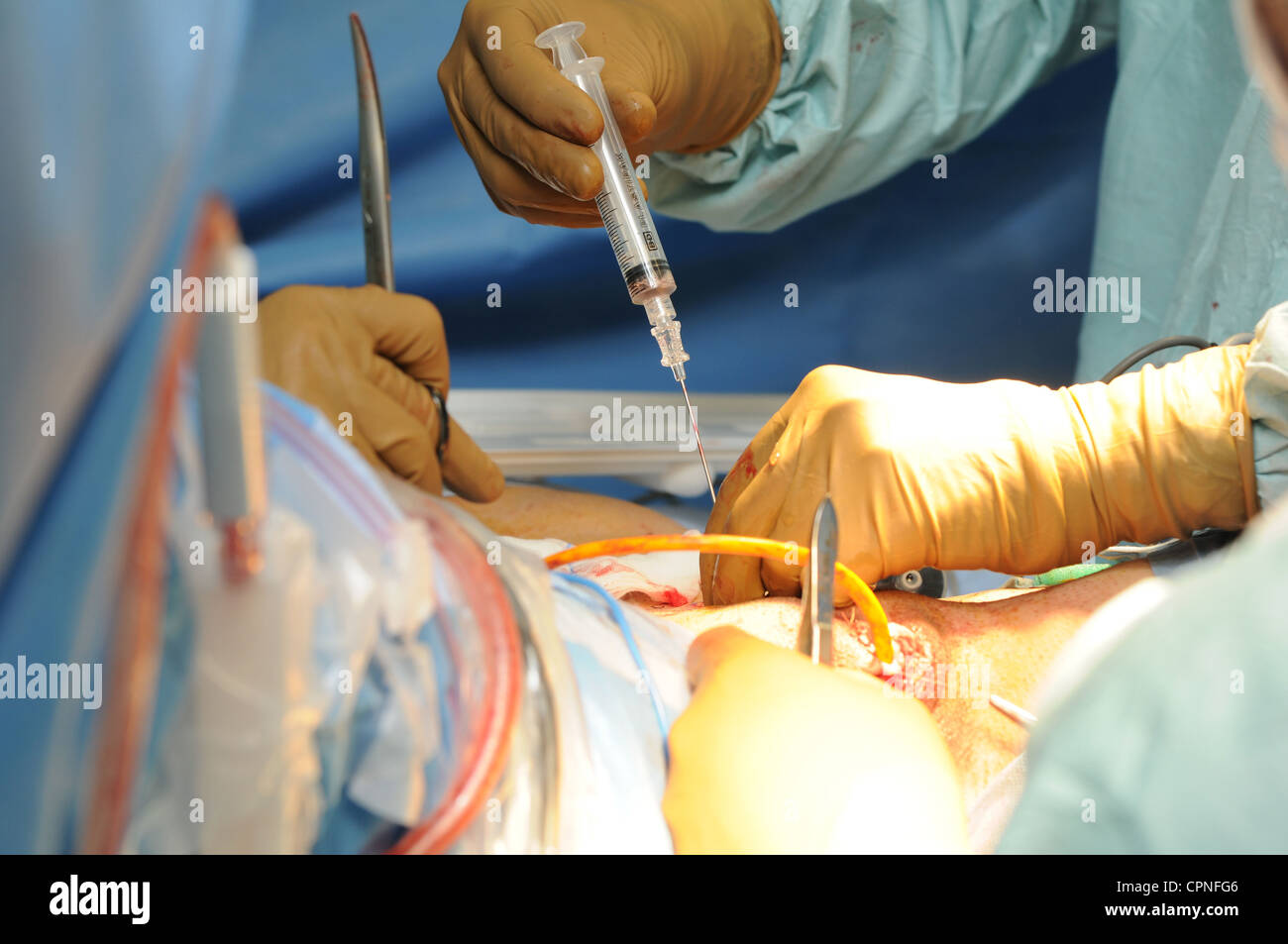 Vaginectomy hi-res stock photography and images - Alamy