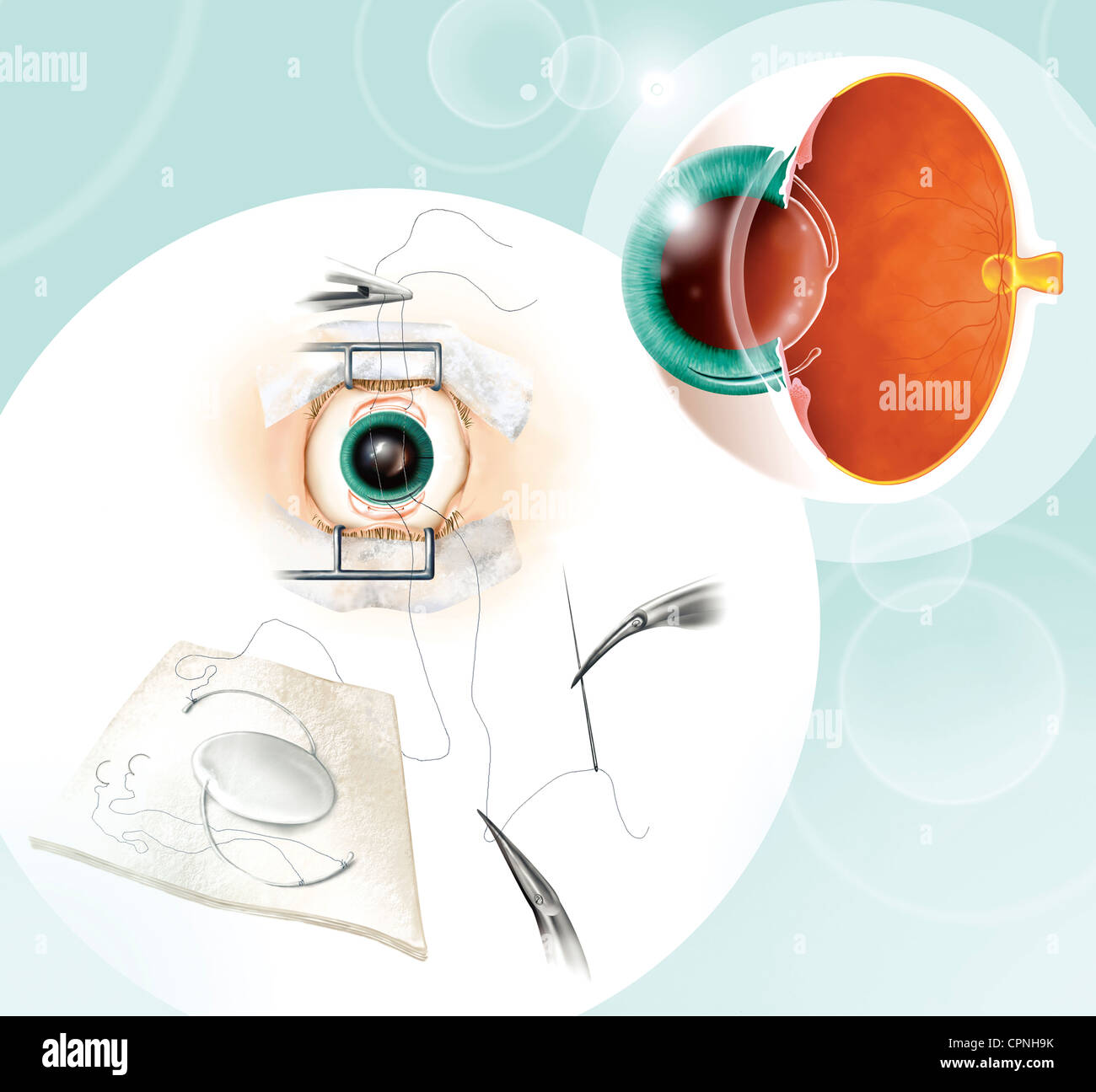 Intraocular lens placement hi-res stock photography and images - Alamy