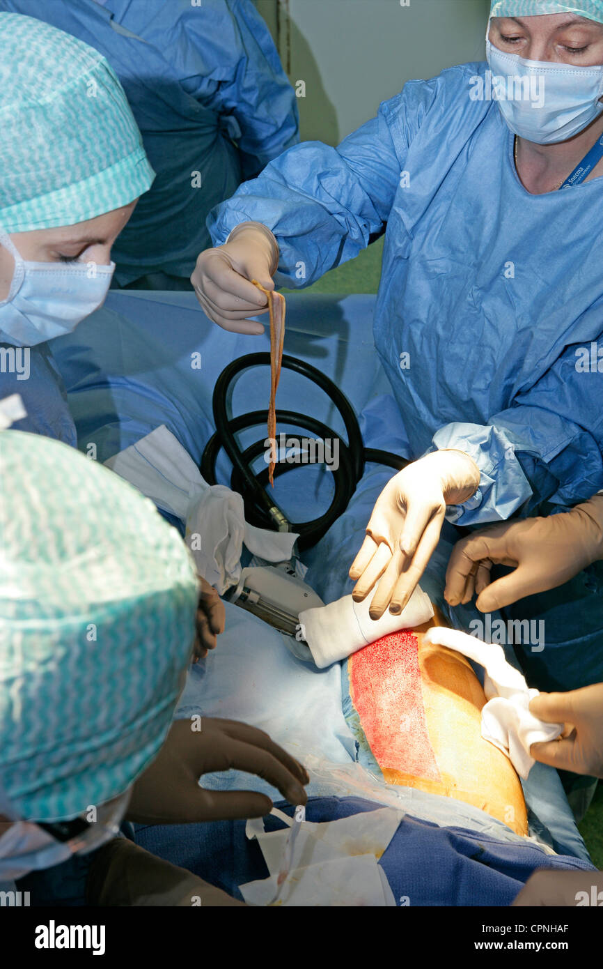 Autologous transplantations hi-res stock photography and images - Alamy