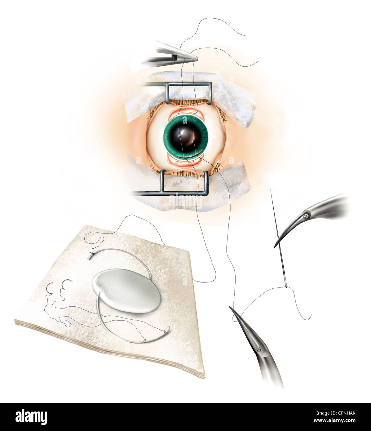 Prosthetic intraocular lens hi-res stock photography and images - Alamy