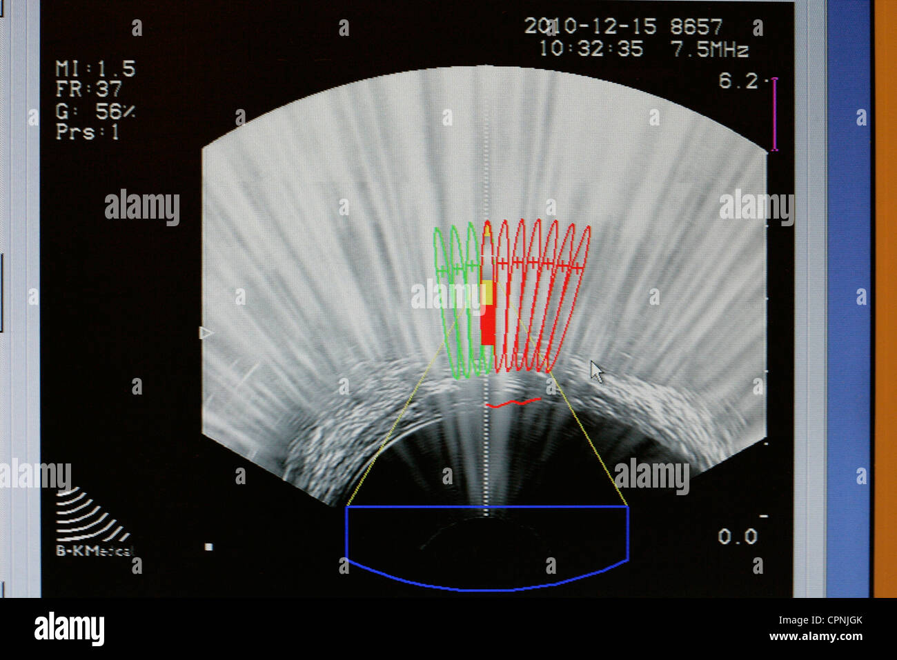 CANCER OF PROSTATE ULTRASOUND Stock Photo - Alamy