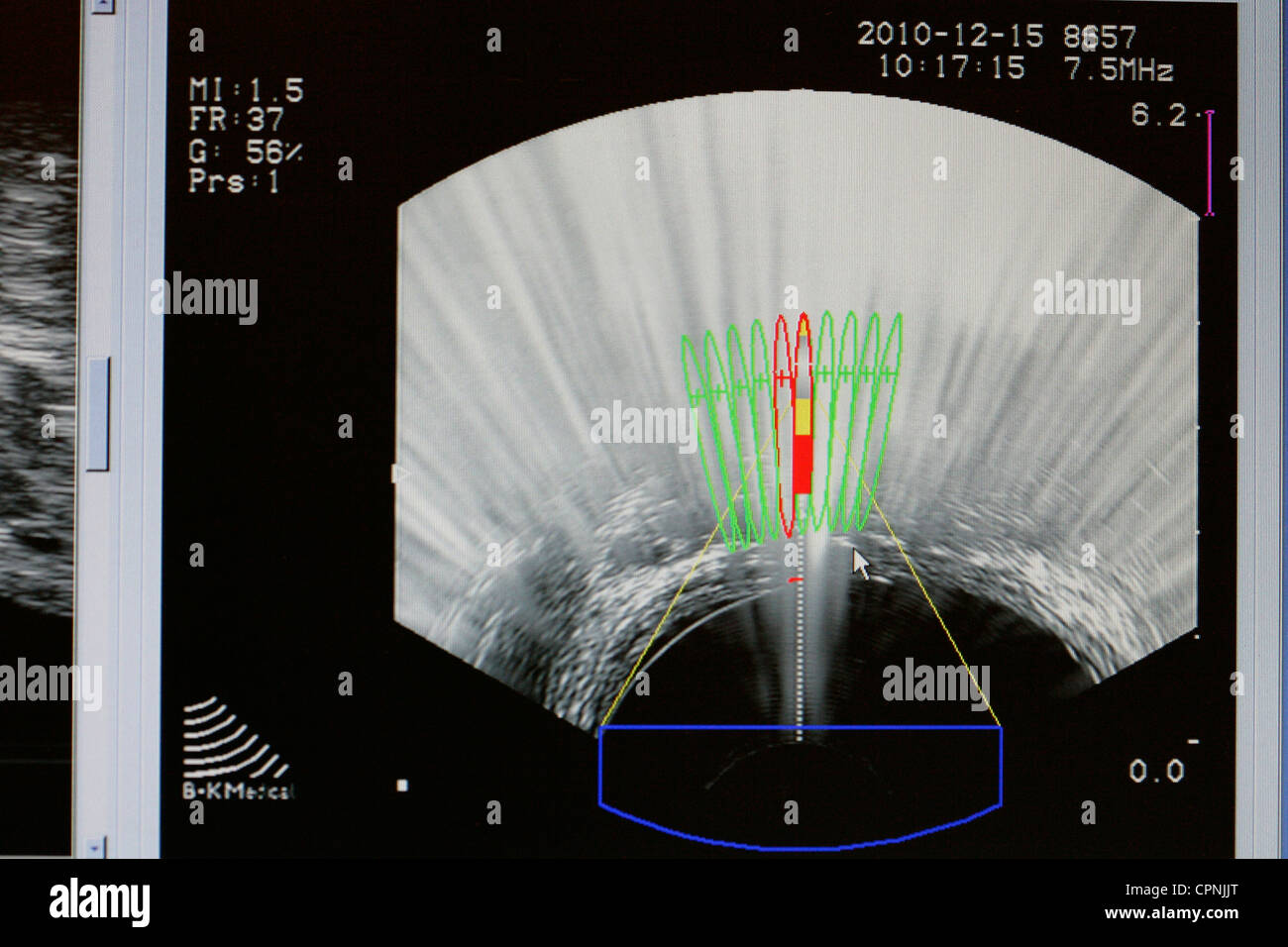 CANCER OF PROSTATE ULTRASOUND Stock Photo - Alamy