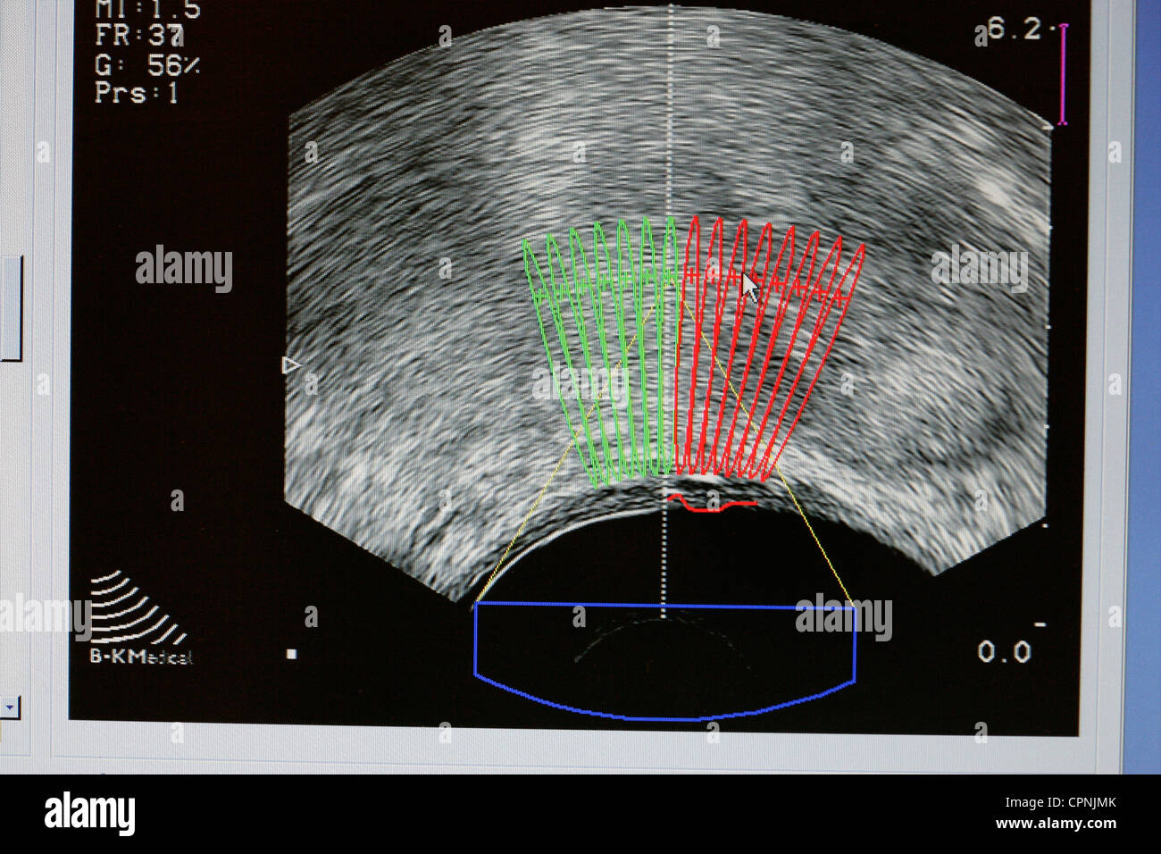 Ultrasound prostatic hi-res stock photography and images - Alamy