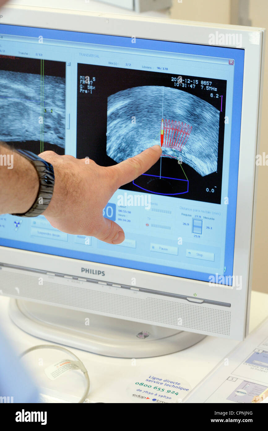 CANCER OF PROSTATE ULTRASOUND Stock Photo - Alamy