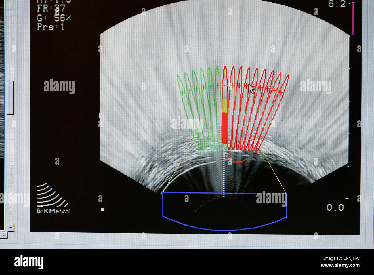 CANCER OF PROSTATE ULTRASOUND Stock Photo - Alamy