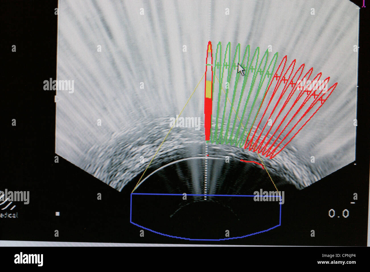 CANCER OF PROSTATE ULTRASOUND Stock Photo - Alamy