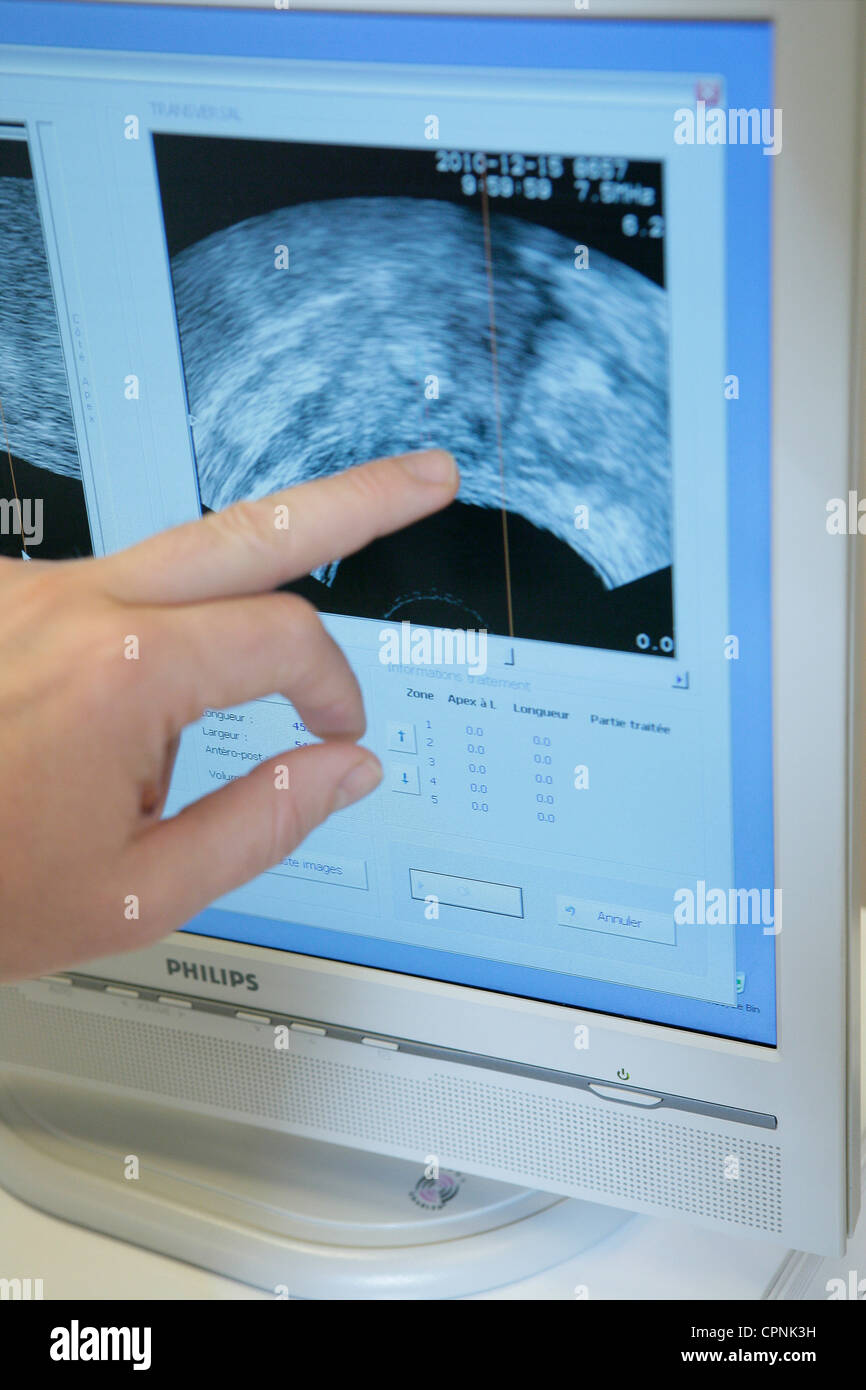 CANCER OF PROSTATE ULTRASOUND Stock Photo - Alamy