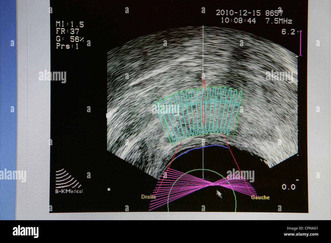 CANCER OF PROSTATE ULTRASOUND Stock Photo - Alamy