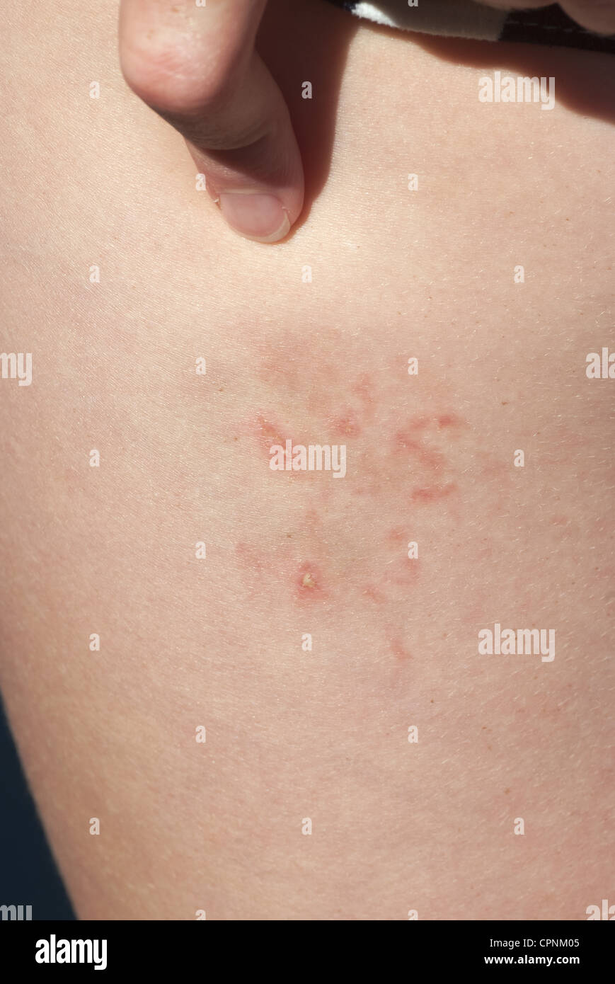 Mosquitoes bite hi-res stock photography and images - Alamy