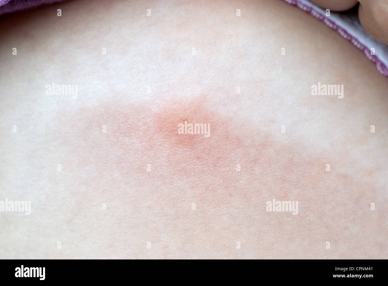 Mosquitoes bite hi-res stock photography and images - Alamy