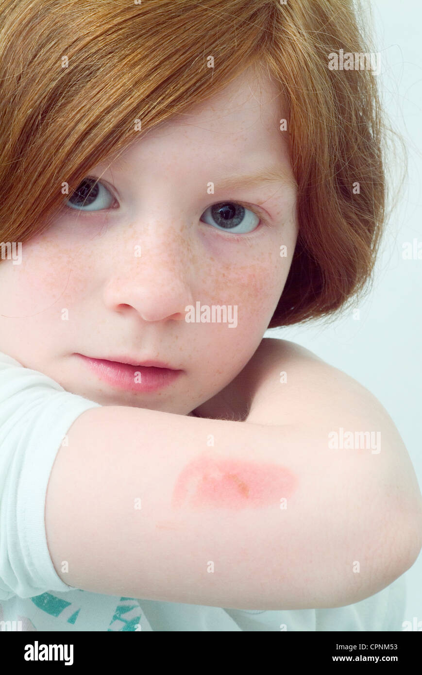 Burned skin child hi-res stock photography and images - Alamy