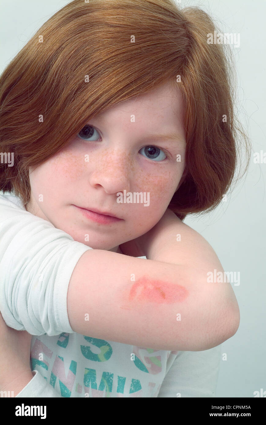 Burned Skin Child High Resolution Stock Photography and Images - Alamy