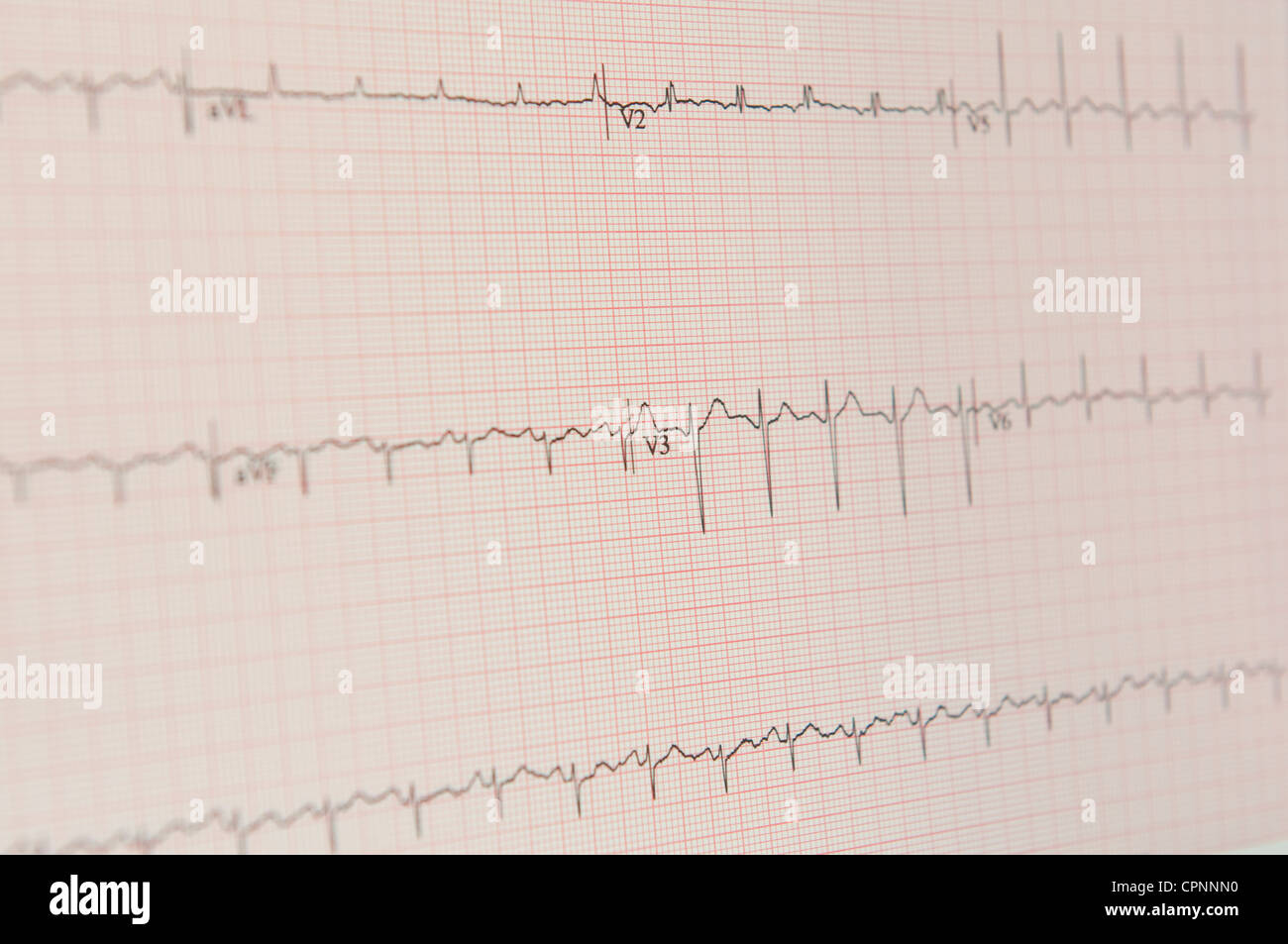 Ecg Tracing High Resolution Stock Photography and Images - Alamy
