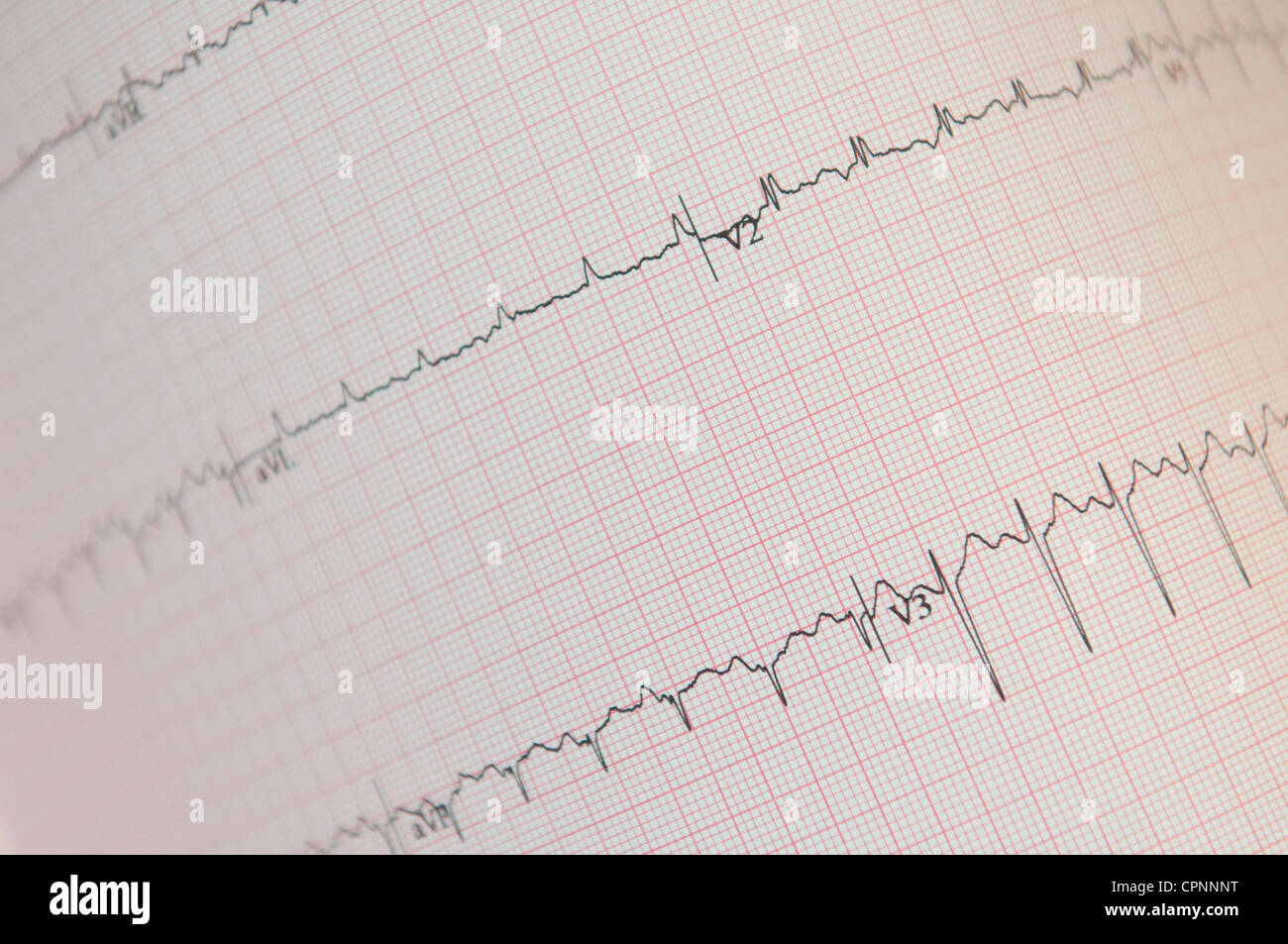 Ecg heart tracing hi-res stock photography and images - Alamy