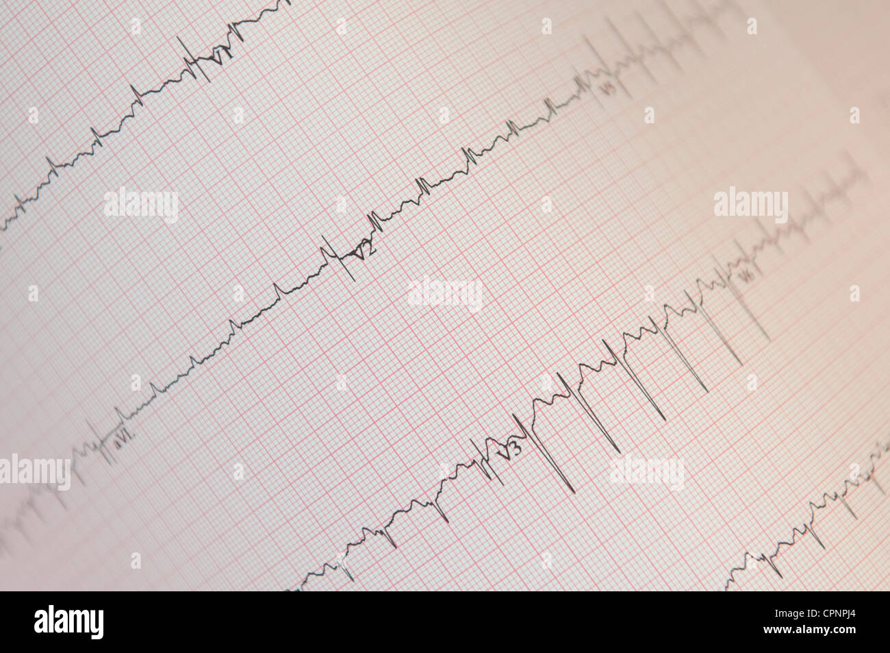 Ecg heart tracing hi-res stock photography and images - Alamy