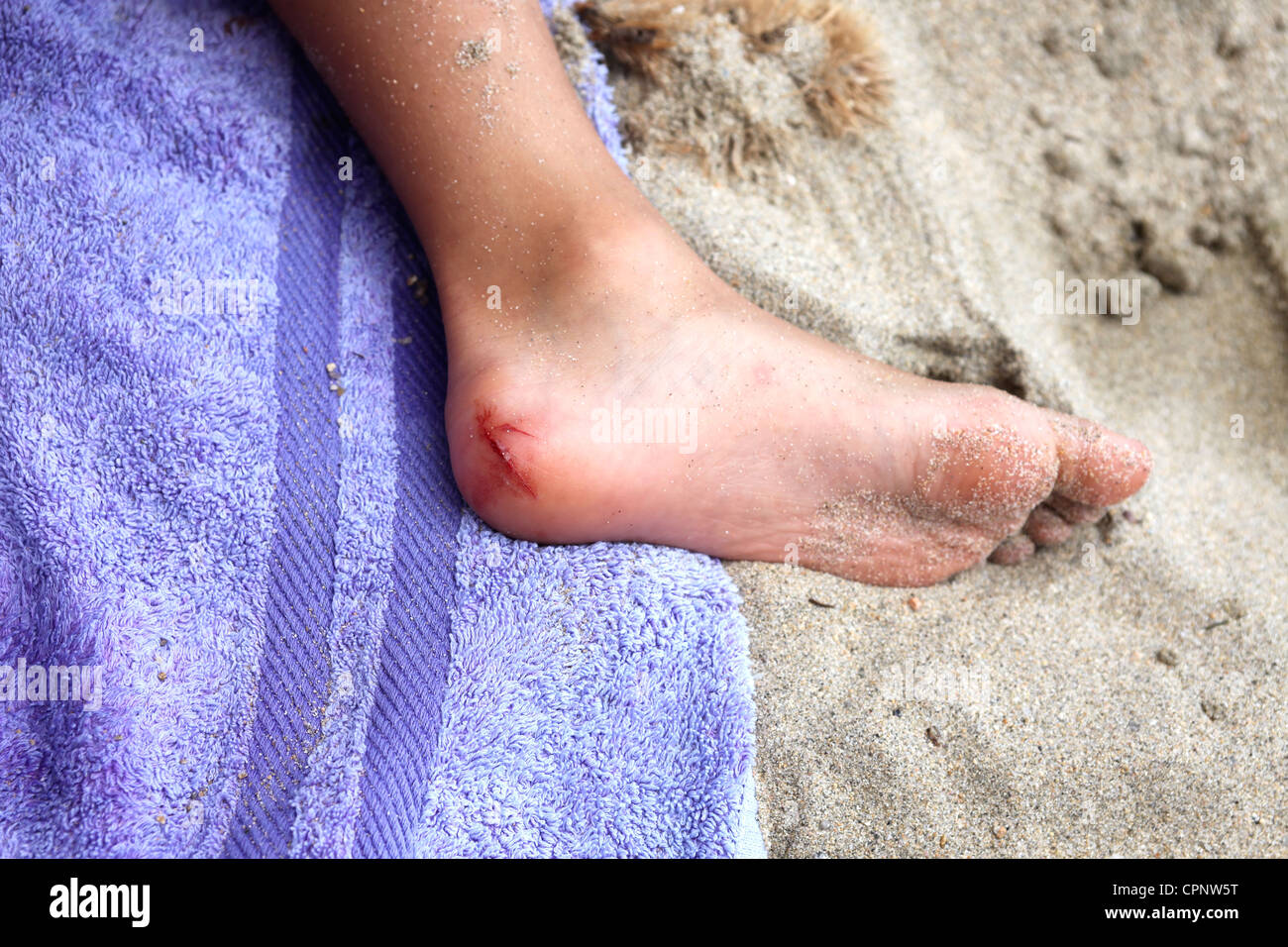 Open wound hi-res stock photography and images - Alamy