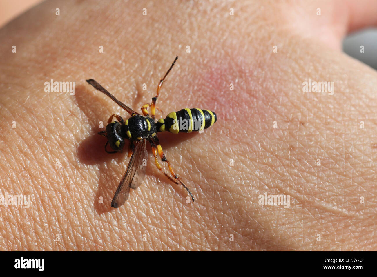 Wasp sting human hi-res stock photography and images - Alamy