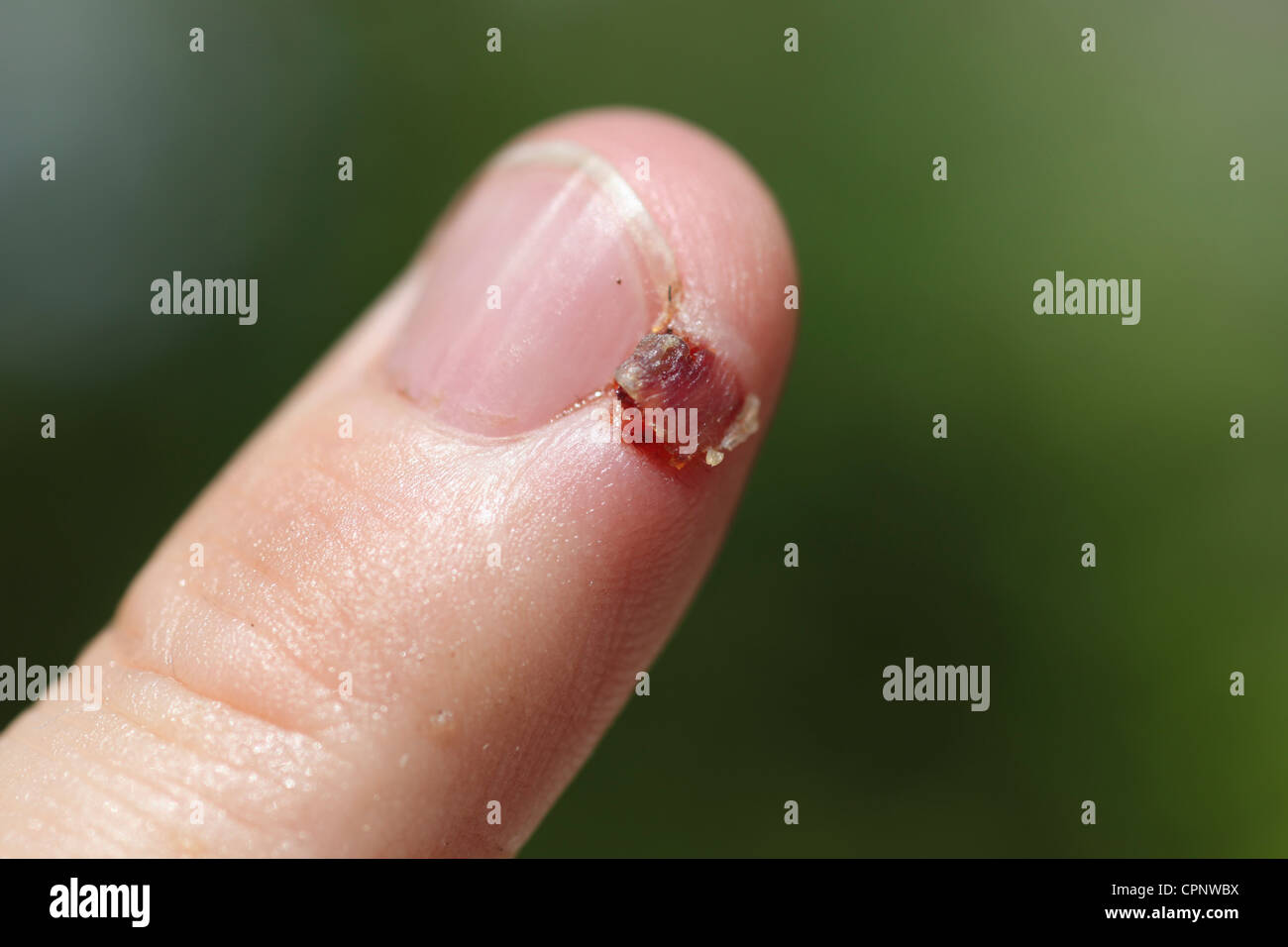 Open sores hi-res stock photography and images - Alamy