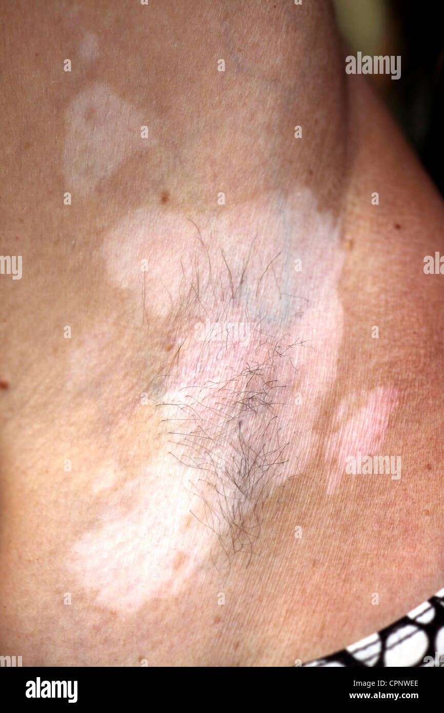 Vitiligo hi-res stock photography and images - Alamy