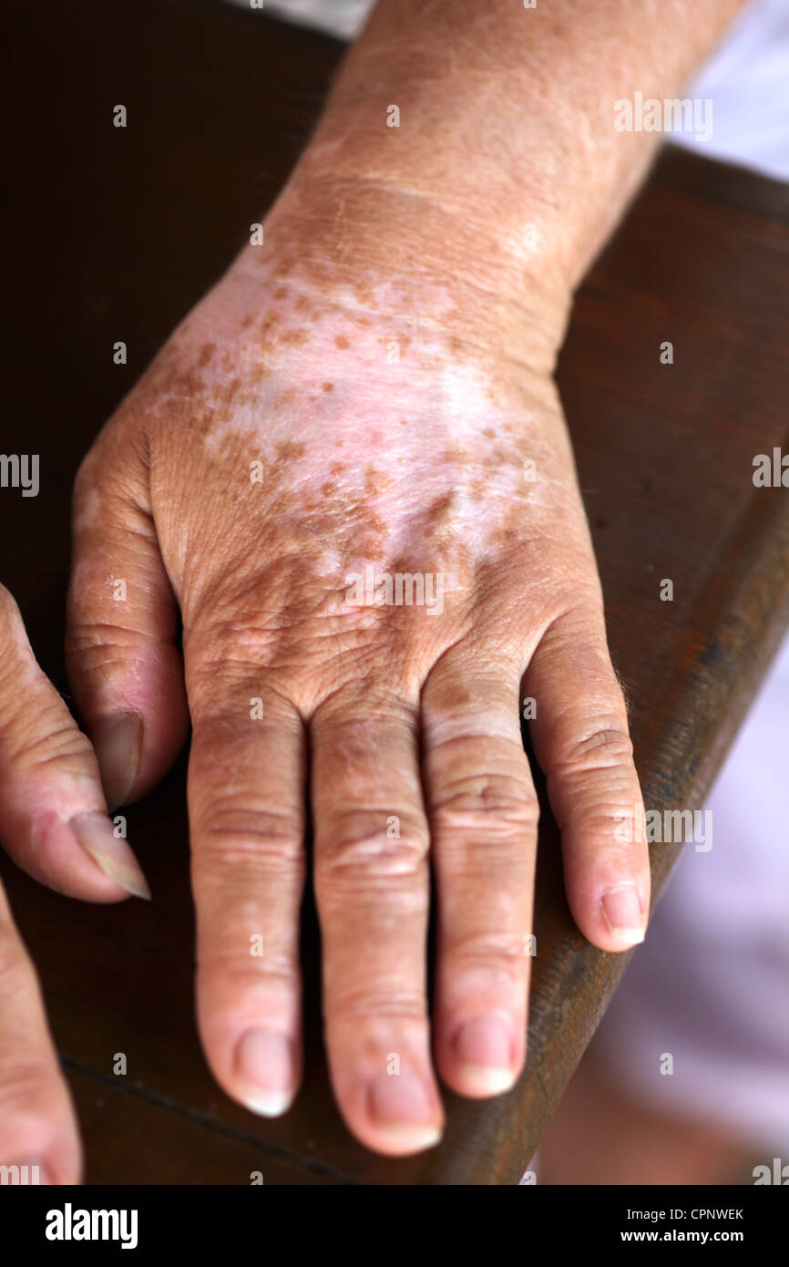 Leukoderma High Resolution Stock Photography and Images - Alamy