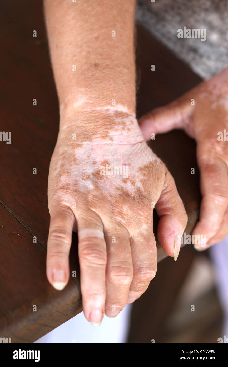 Vitiligo skin condition hi-res stock photography and images - Alamy