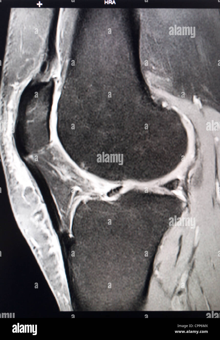 KNEE, MRI Stock Photo - Alamy