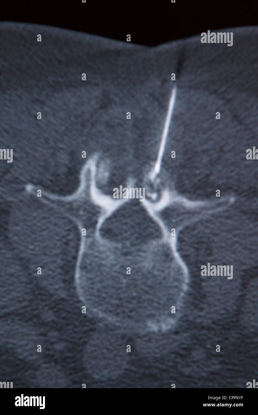 Spinal infiltration hi-res stock photography and images - Alamy