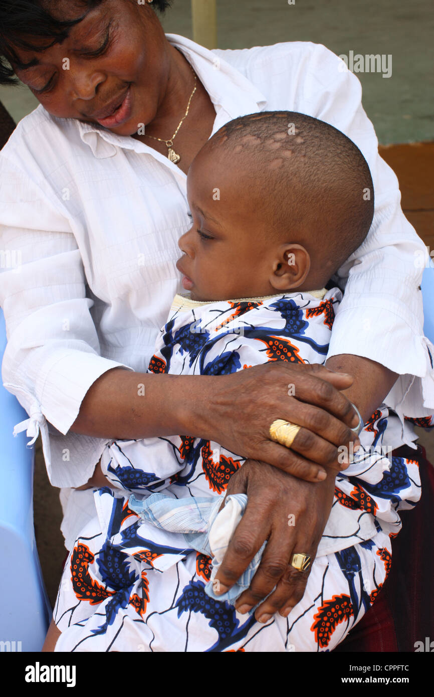 Hydrocephalus Baby Signs