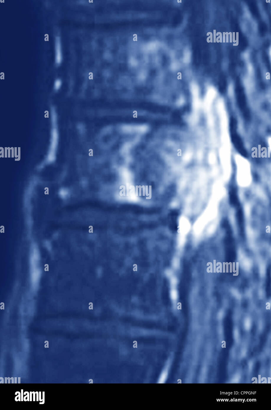 METASTASIS, THORACIC VERTEBRAE Stock Photo - Alamy