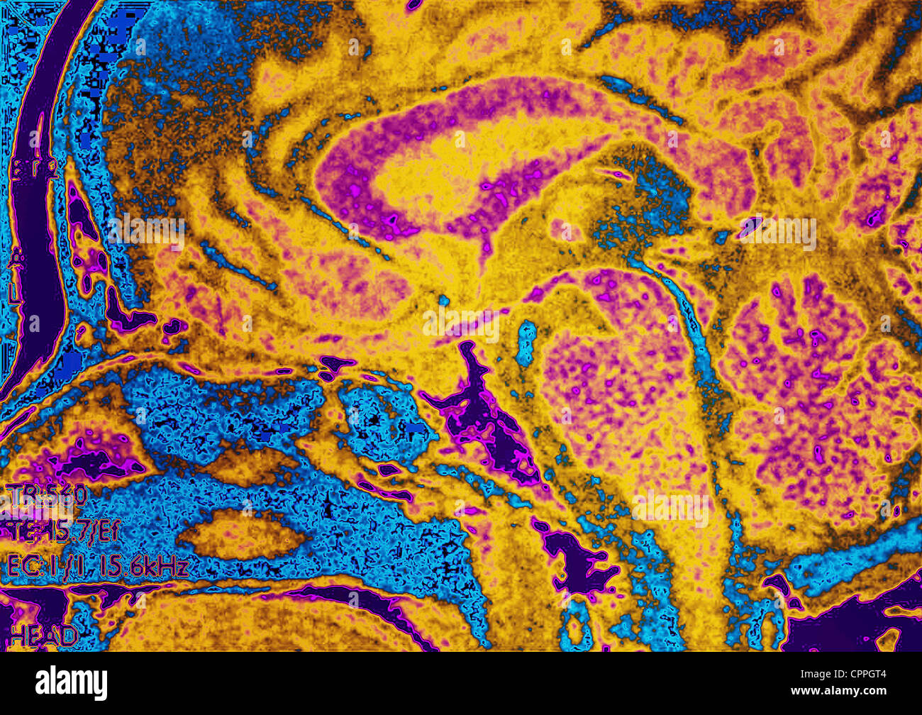 Brain atrophy hi-res stock photography and images - Alamy