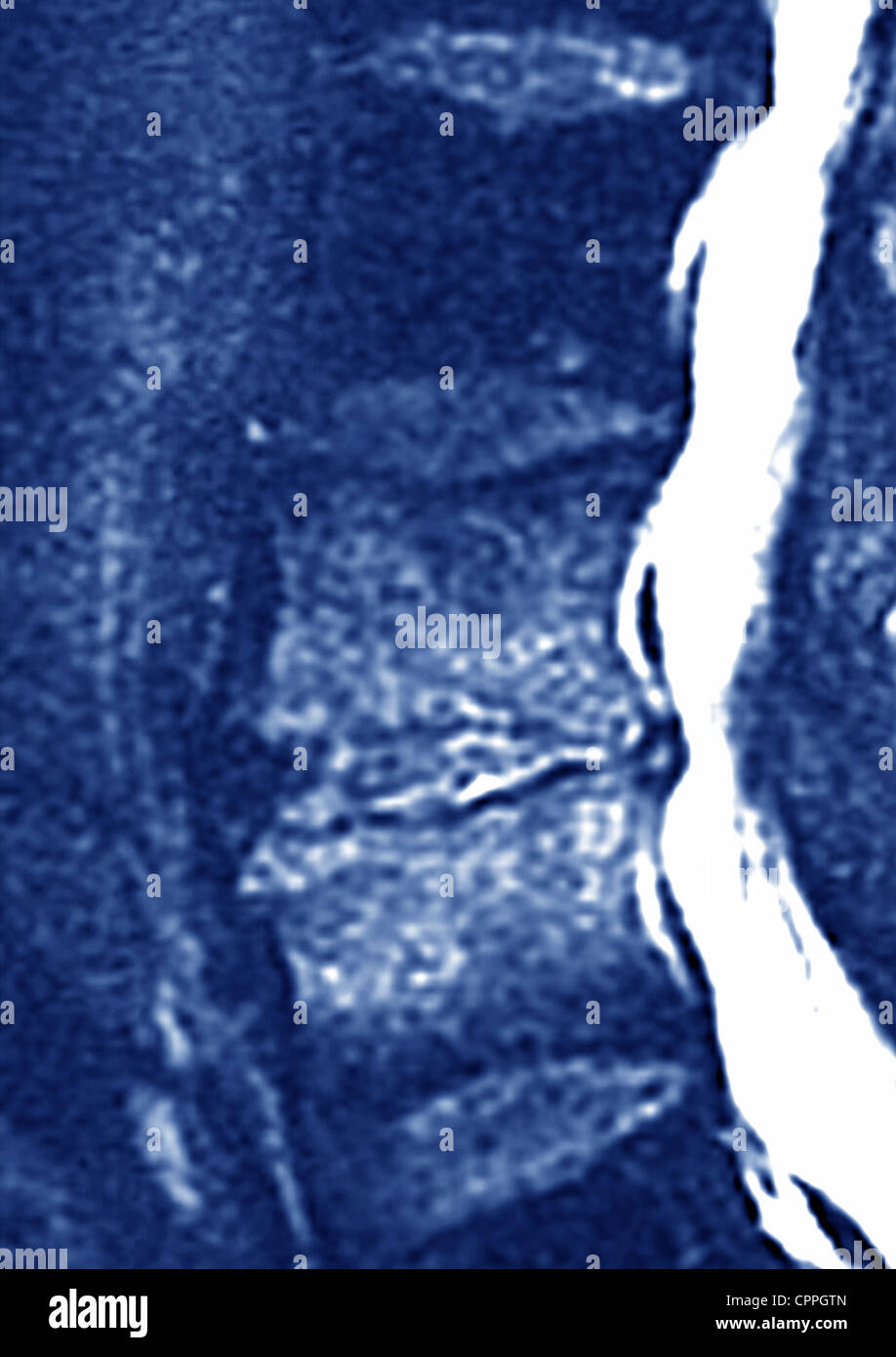 Spondylodiscitis mri hi-res stock photography and images - Alamy