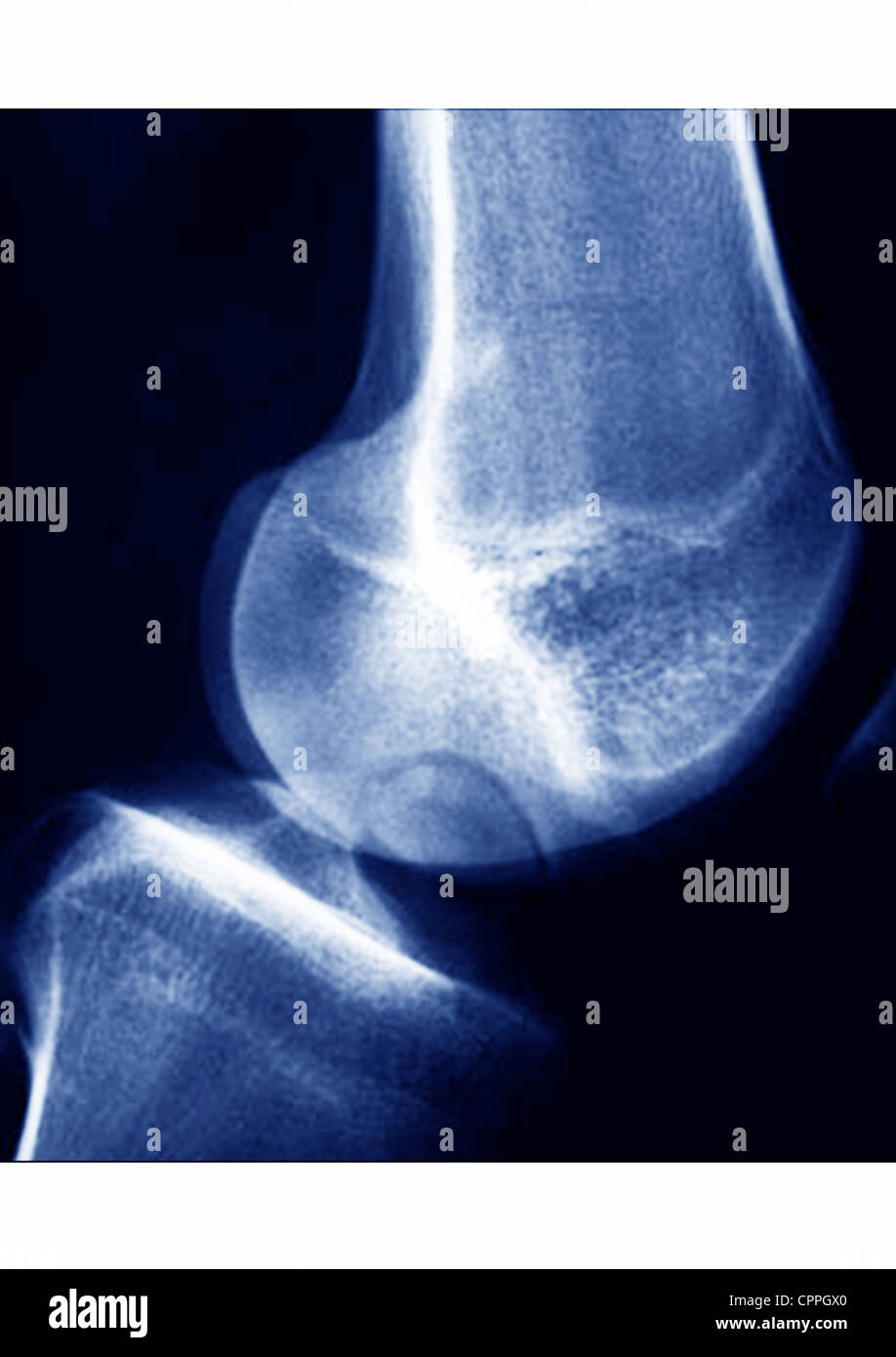 Femoral condyles hi-res stock photography and images - Alamy