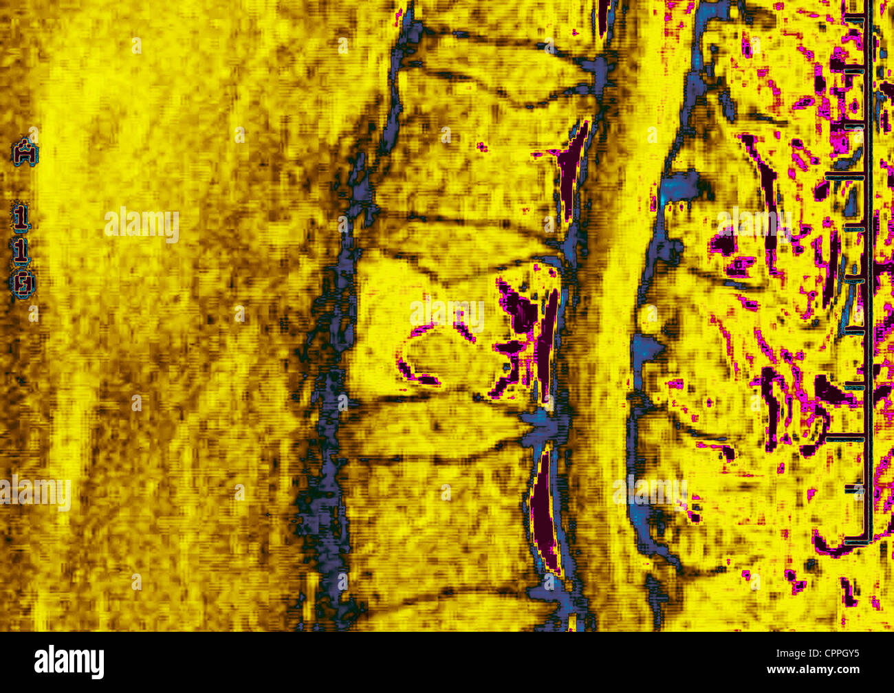 Myeloma hi-res stock photography and images - Alamy