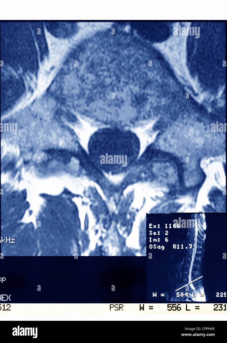 Spondylodiscitis mri hi-res stock photography and images - Alamy