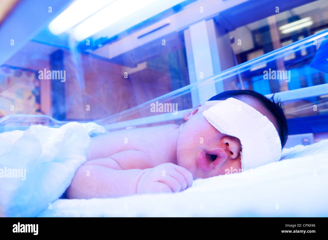 Jaundice baby hi-res stock photography and images - Alamy