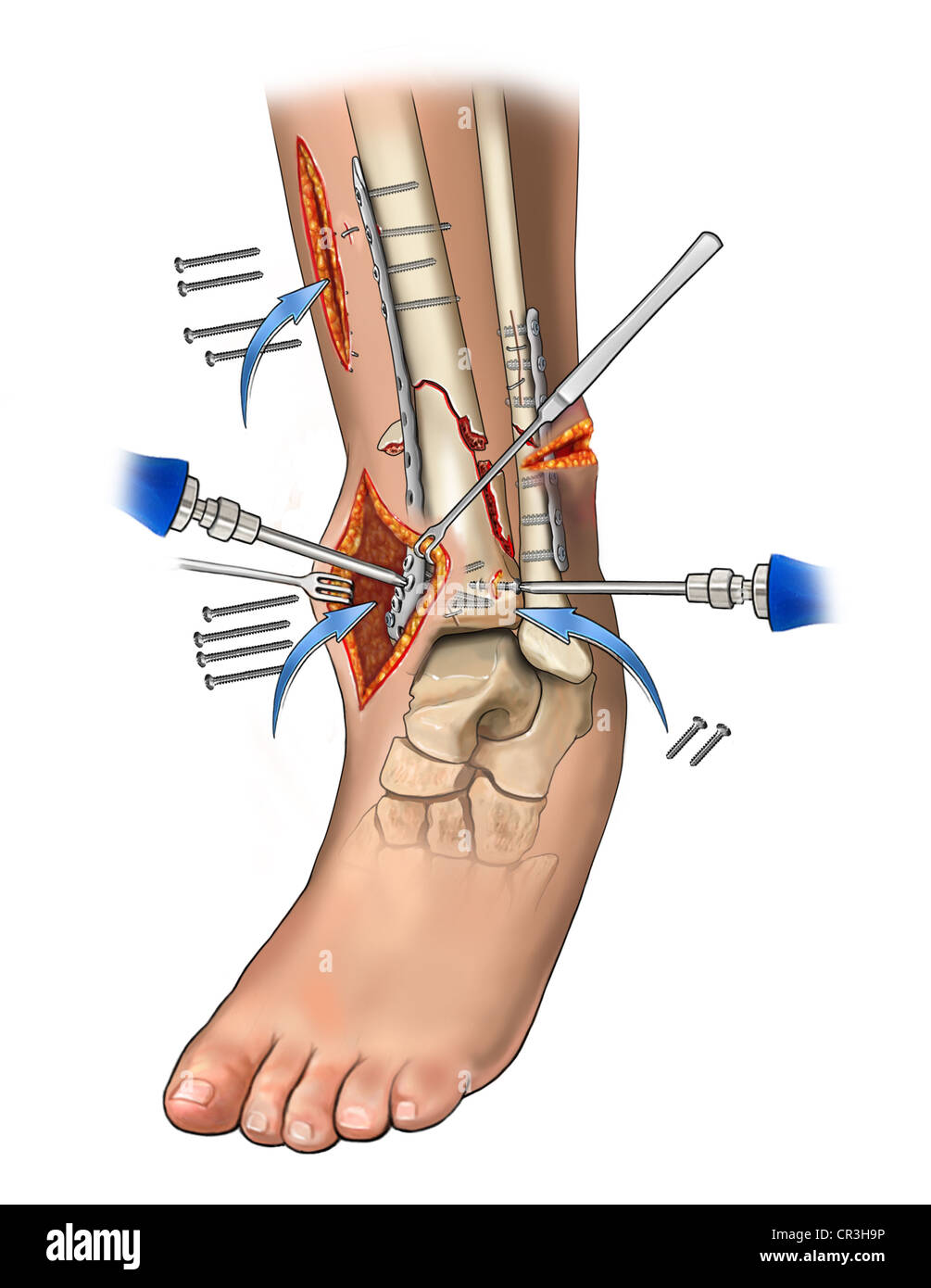 Tibia fibular fracture hi-res stock photography and images - Alamy