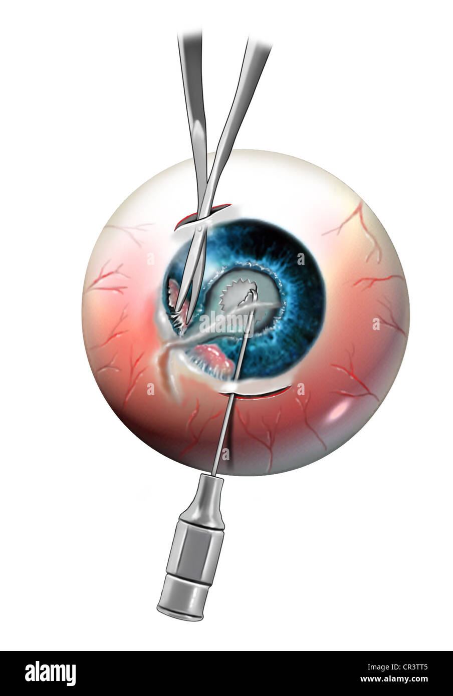 Eye surgery tools hi-res stock photography and images - Alamy