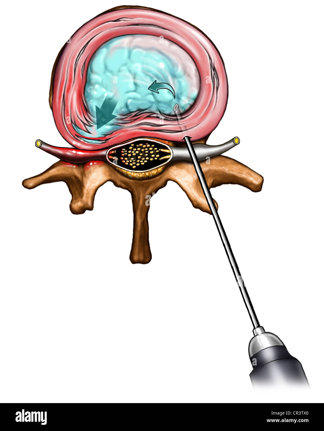 Lumbar Injection High Resolution Stock Photography and Images - Alamy